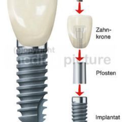 Fixierung - DocCheck Flexikon