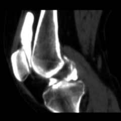 Retrobulbärer Fettkörper - DocCheck Flexikon