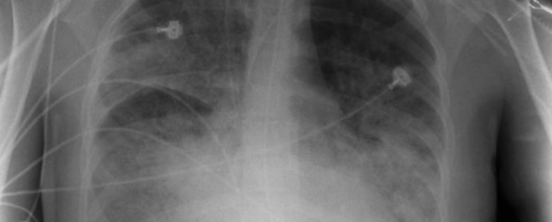 Lungenödem: Pathomechanismus entschlüsselt - DocCheck