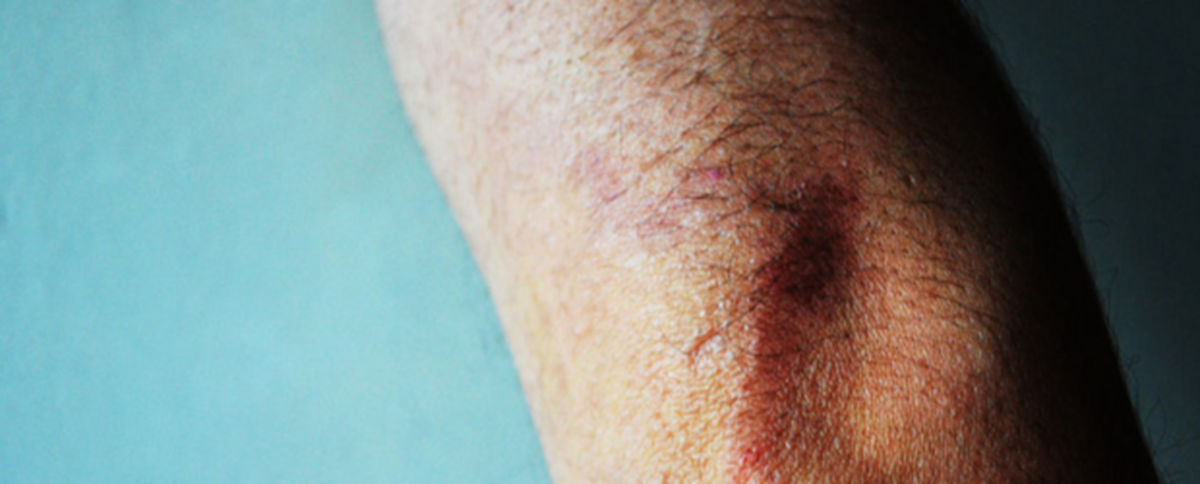 Wie Hautwunden heilen - DocCheck