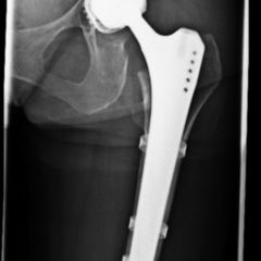 Cerclage - DocCheck Flexikon