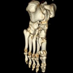 Os metatarsale - DocCheck Flexikon