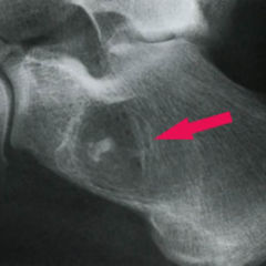 Weichteiltumor - DocCheck Flexikon