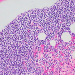 Lymphom - DocCheck Flexikon