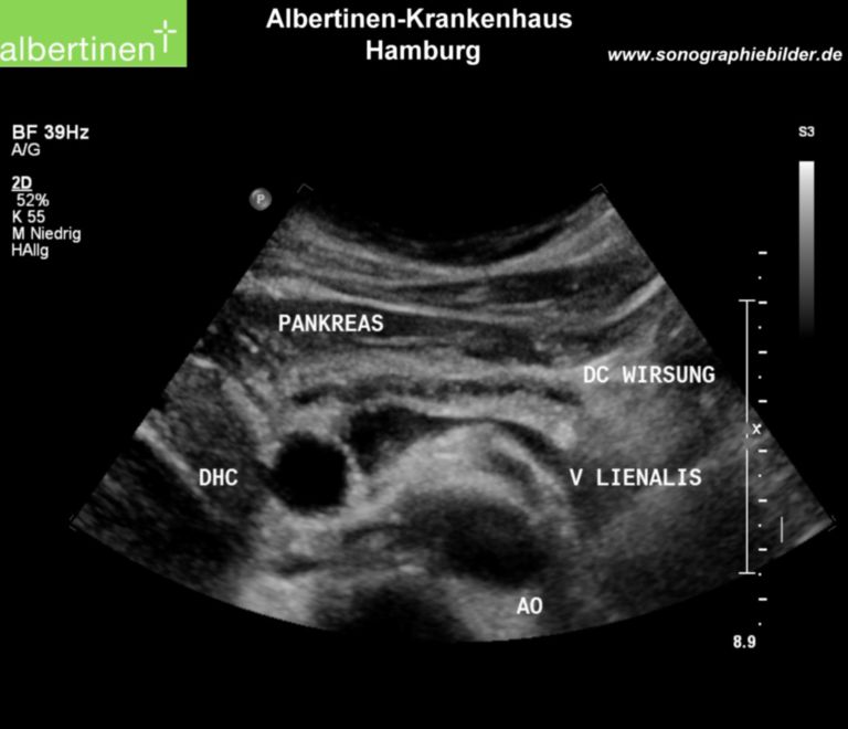 Chron. Pankreatitis Gang Sono - DocCheck
