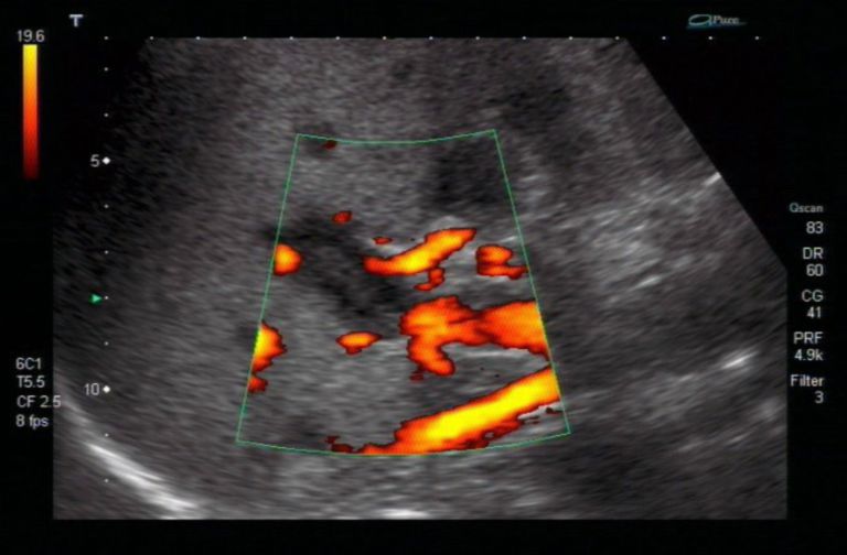 Trombosi della vena porta - DocCheck
