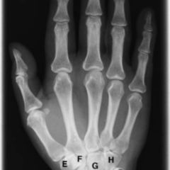 Handwurzelknochen - DocCheck Flexikon