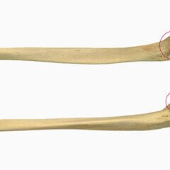 Processus coronoideus ulnae - DocCheck Flexikon