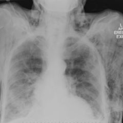 Emphysem - DocCheck Flexikon