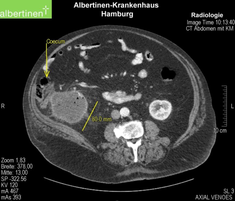 CT perityphlitischer Abszess - DocCheck