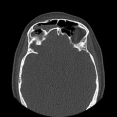 Sinus coronarius - DocCheck Flexikon