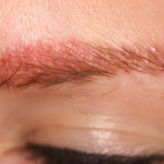 Epikutantest - DocCheck Flexikon