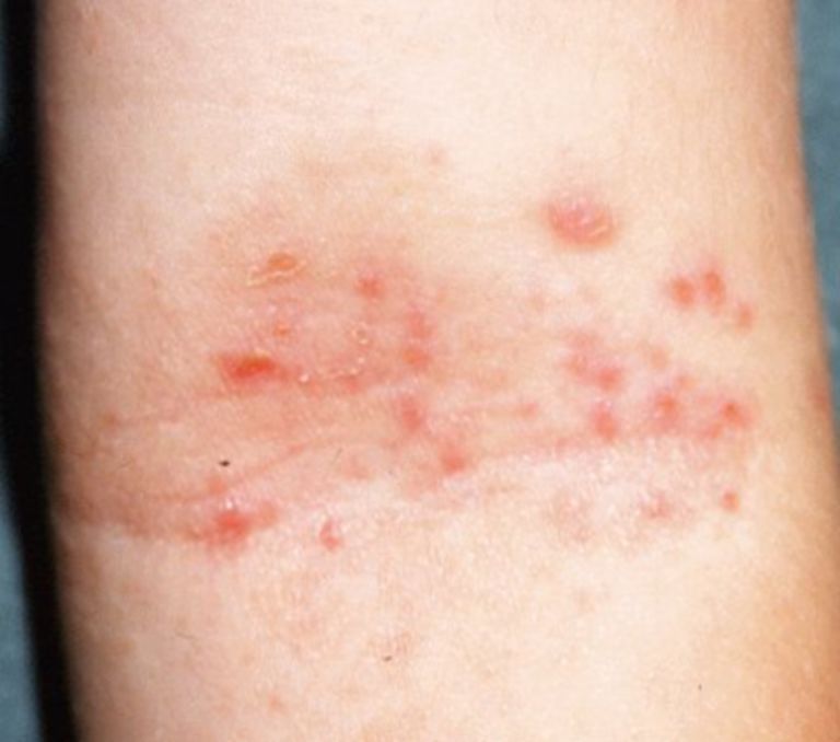Skin lesions in atopic dermatitis - DocCheck