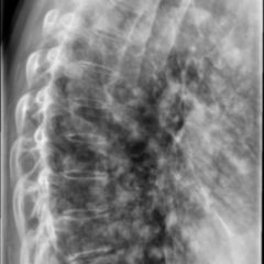 Malignom - DocCheck Flexikon