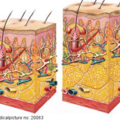 Cellulite - DocCheck Flexikon