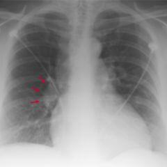 Palla-Zeichen - DocCheck Flexikon