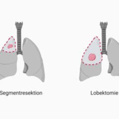 Segmentresektion - DocCheck Flexikon