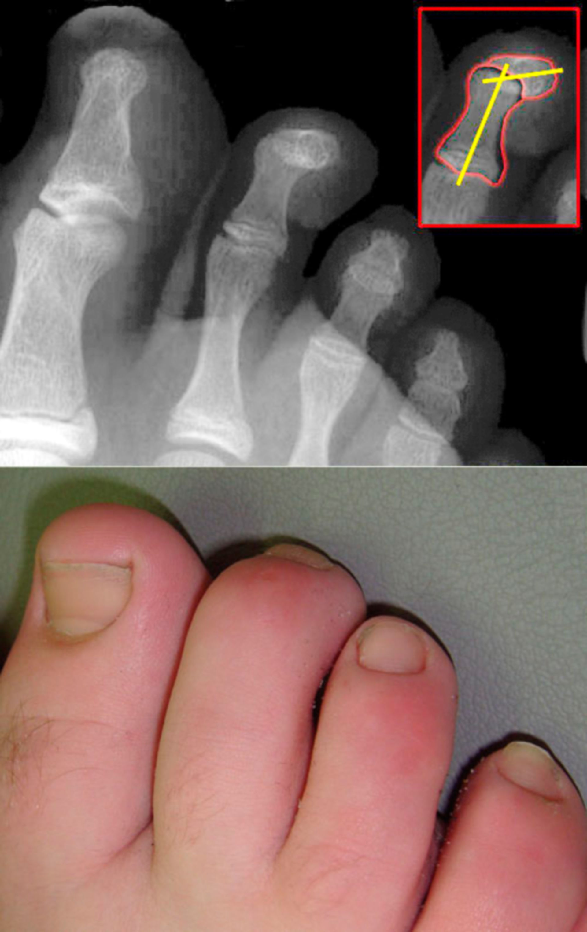 Hammer Toe DocCheck Hammer Toe DocCheck