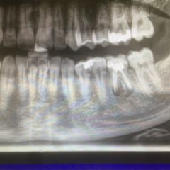 Zahnwurzel - DocCheck Flexikon