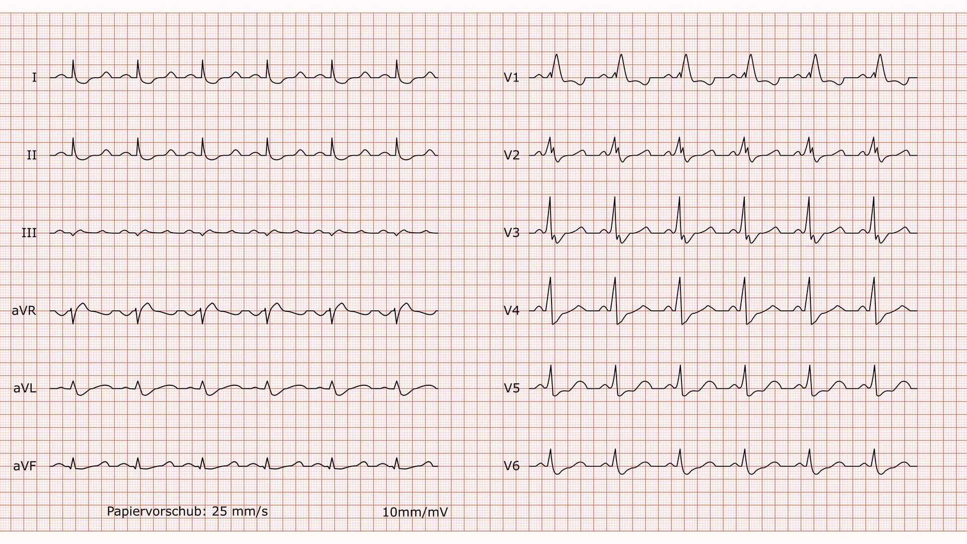 12-Kanal-EKG bei komplettem Rechtsschenkelblock - DocCheck