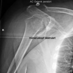 Omarthrose - DocCheck Flexikon