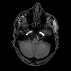 Nodulus vermis - DocCheck Flexikon