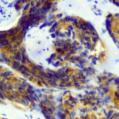 Knochenmetastase - DocCheck Flexikon