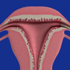 Ovarialkarzinom - DocCheck Flexikon