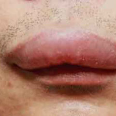 Angioödem - DocCheck Flexikon