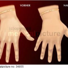 Ödem - DocCheck Flexikon