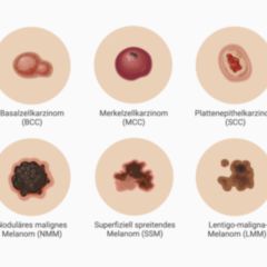Merkelzellkarzinom - DocCheck Flexikon