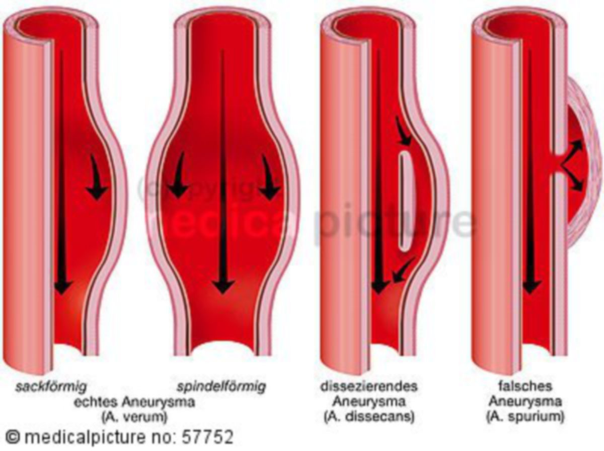 Aneurysma - DocCheck