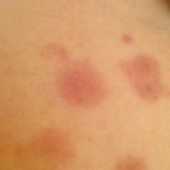 Effloreszenz - DocCheck Flexikon