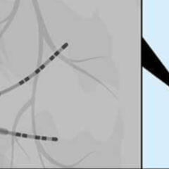 Ablatio - DocCheck Flexikon