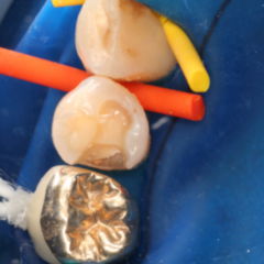 Kofferdam - DocCheck Flexikon