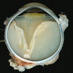 Netzhautablösung - DocCheck Flexikon