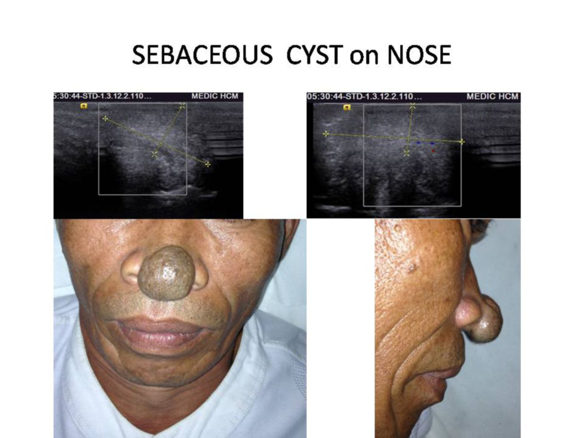 Sebaceous Cyst on Nose - DocCheck