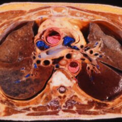 Truncus pulmonalis - DocCheck Flexikon