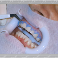 Aufhellung - DocCheck Flexikon