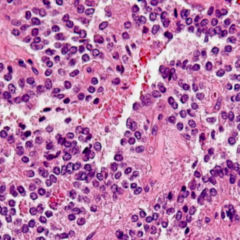 Papillärer Tumor der Pinealisregion - DocCheck Flexikon