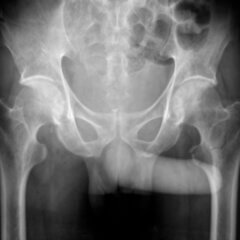 Throckmorton-Zeichen - DocCheck Flexikon