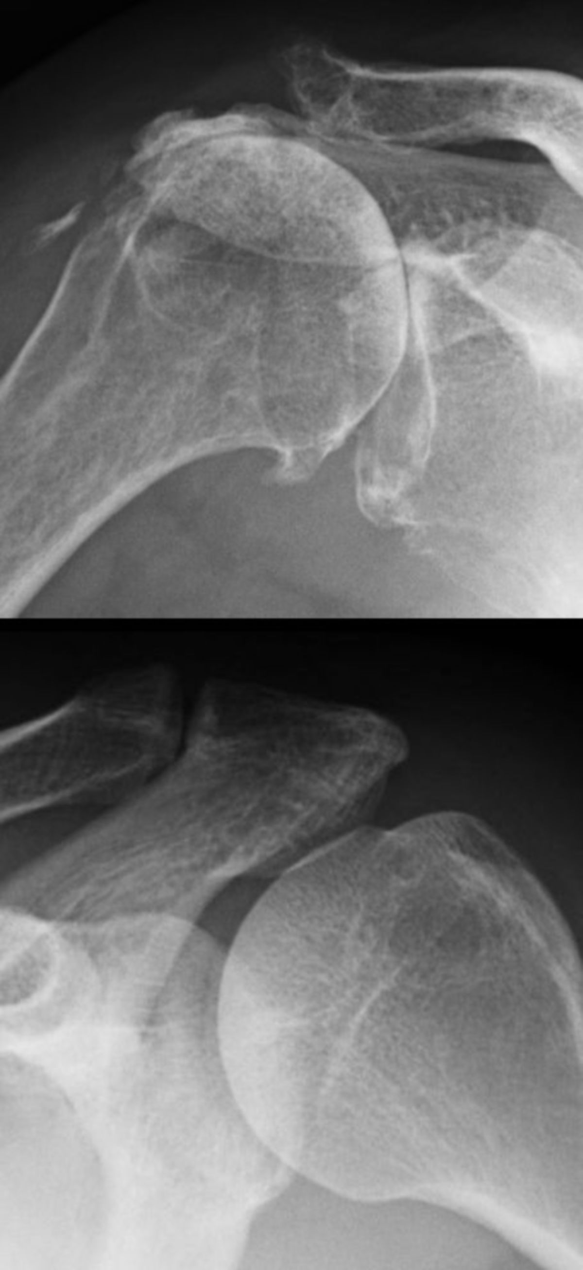 Omarthrose - DocCheck