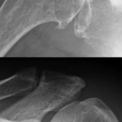 Omarthrose - DocCheck Flexikon