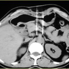 Truncus coeliacus - DocCheck Flexikon
