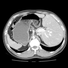 Situs inversus - DocCheck Flexikon
