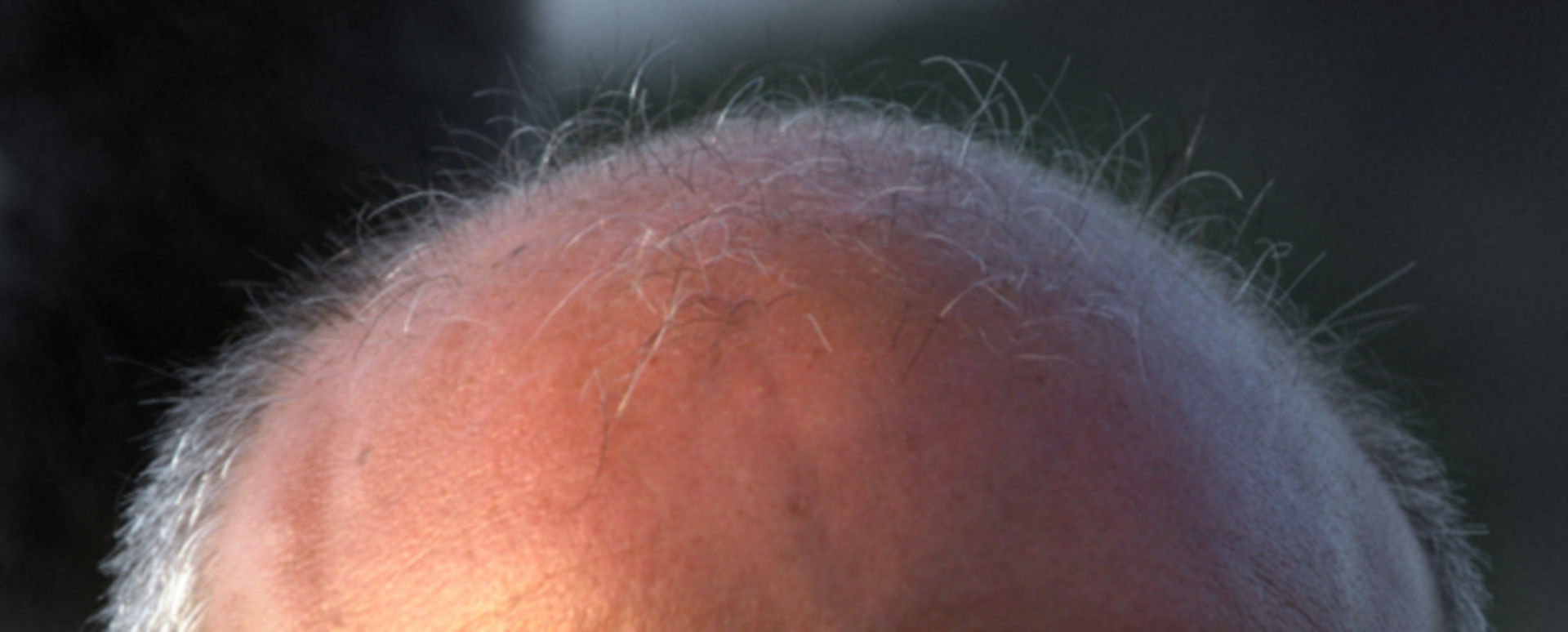 Alopezie: Glätzlein, deck Dich! - DocCheck