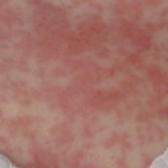 Urtikariell - DocCheck Flexikon