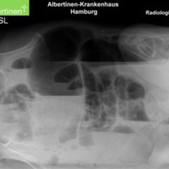 Ileus - DocCheck Flexikon