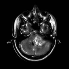 Porus acusticus internus - DocCheck Flexikon