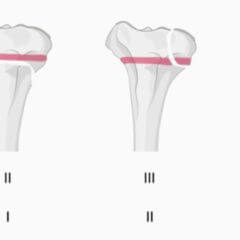 Epiphysenfuge - DocCheck Flexikon
